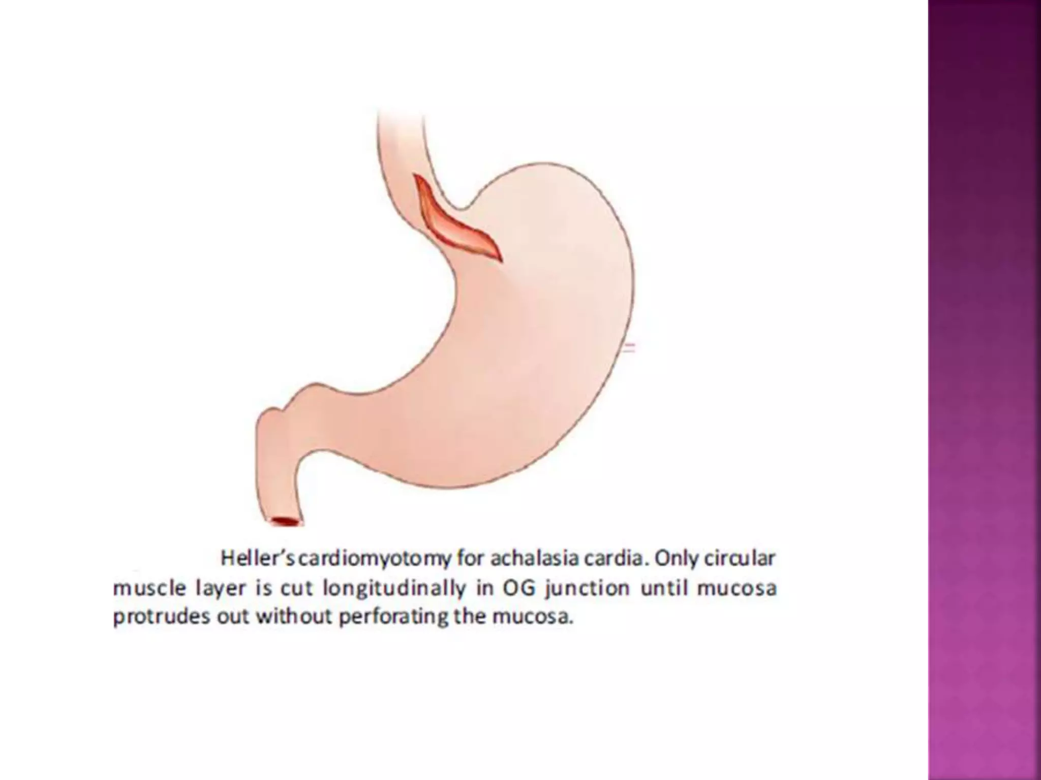 Esophagus : Benign and Malignant diseases | PPTX