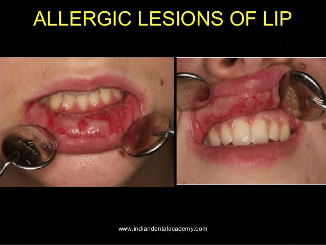 CONTACT ALLERGY OF ORAL MUCOSA/ dental implant courses