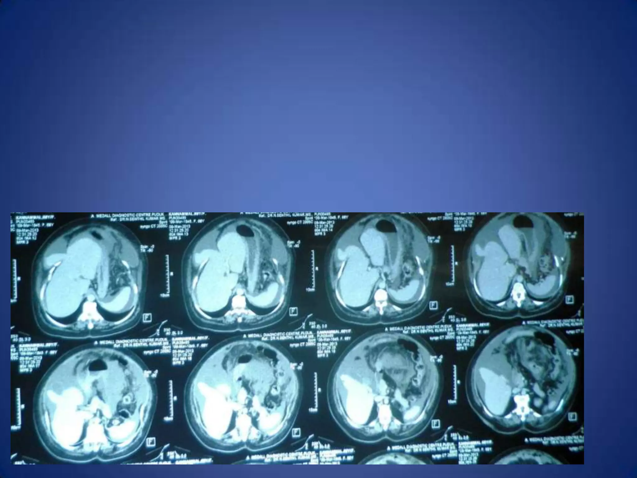 Riedel’s lobe of liver | PPTX