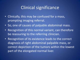 Riedel’s lobe of liver | PPTX | Medical Health