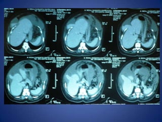 Riedel’s lobe of liver | PPTX