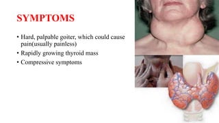 Riedel thyroiditis | PPT