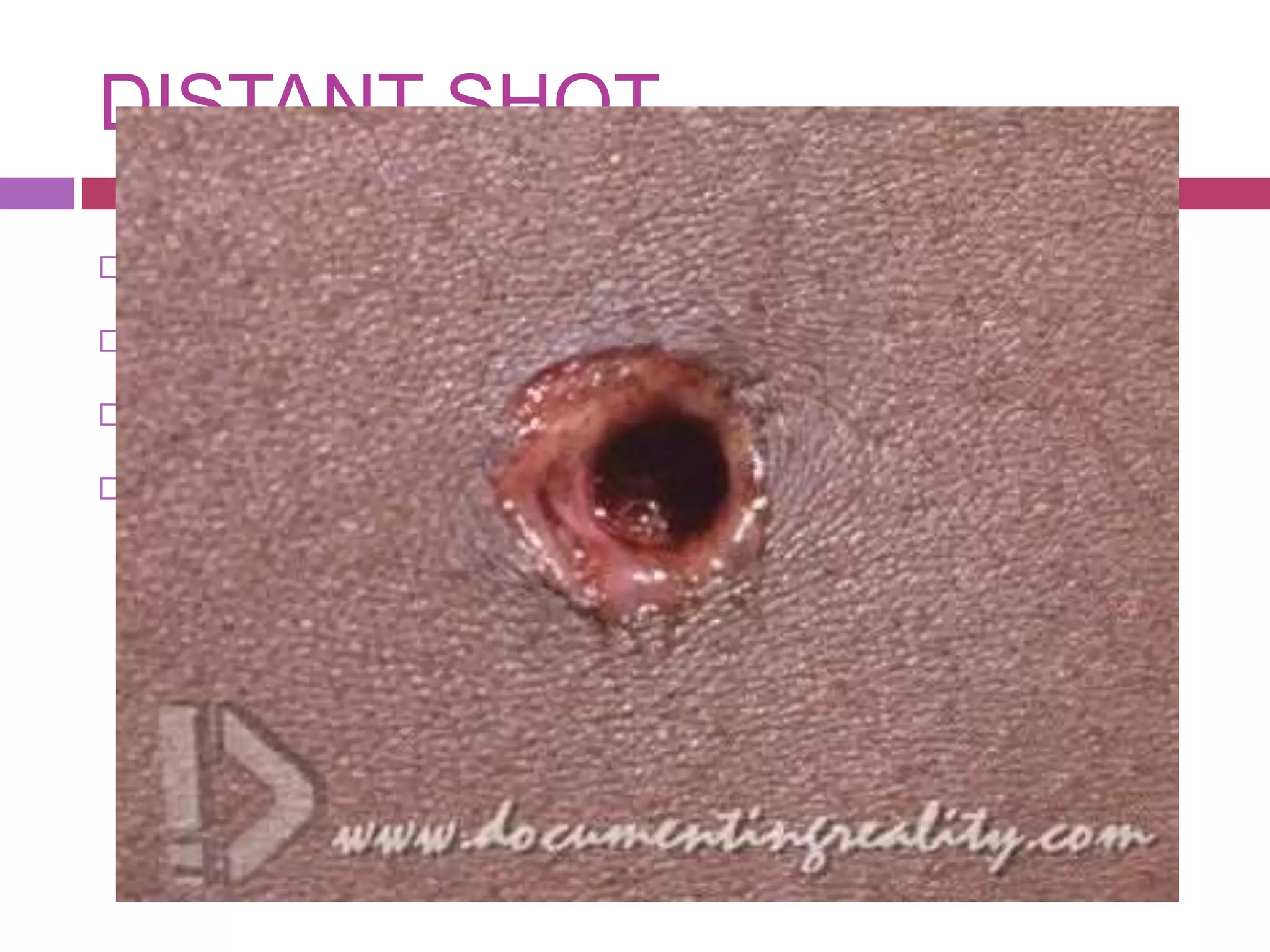 Rifled weapon injuries | PPTX