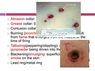 Rifled weapon injuries | PPTX