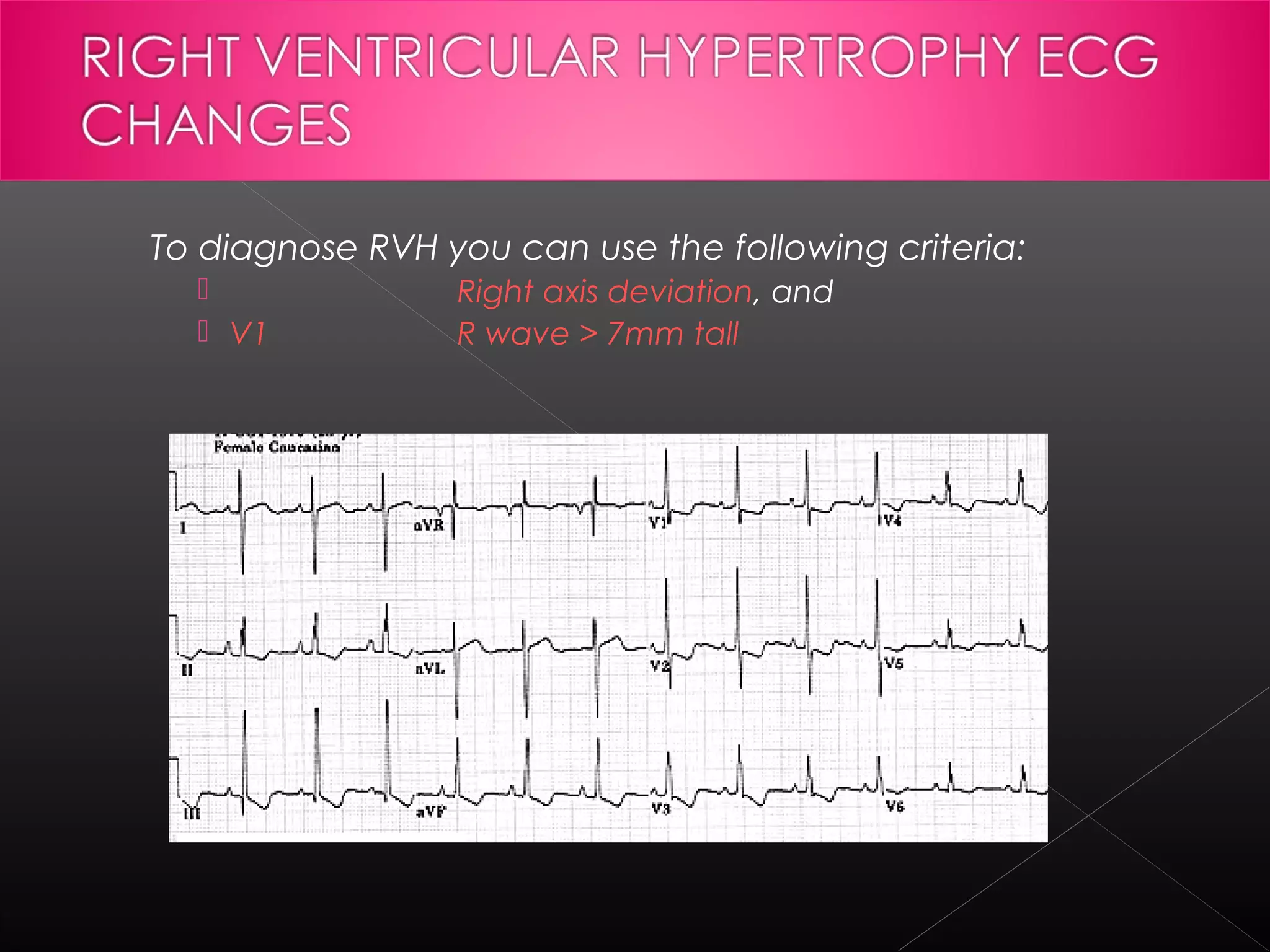 Right and left ventricular hypertrophy | PPT