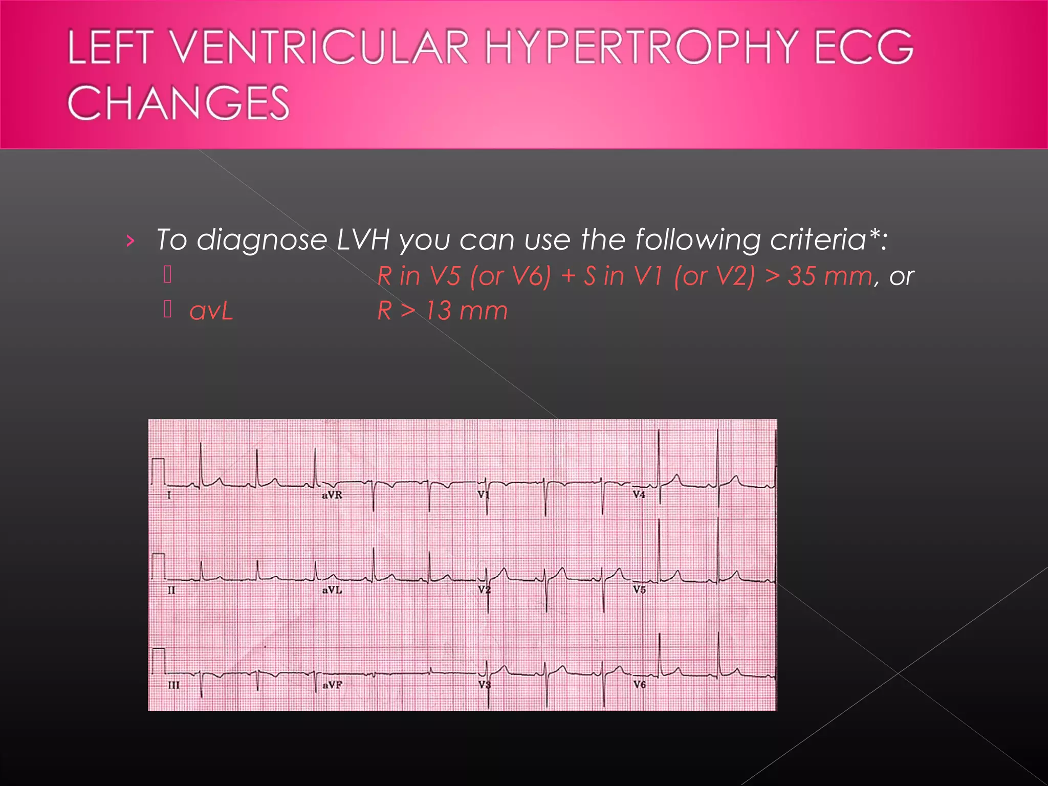 Right and left ventricular hypertrophy | PPT