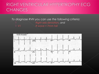 Right and left ventricular hypertrophy | PPT