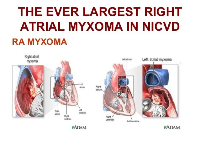 Right Atrial Myxoma - A Case Report