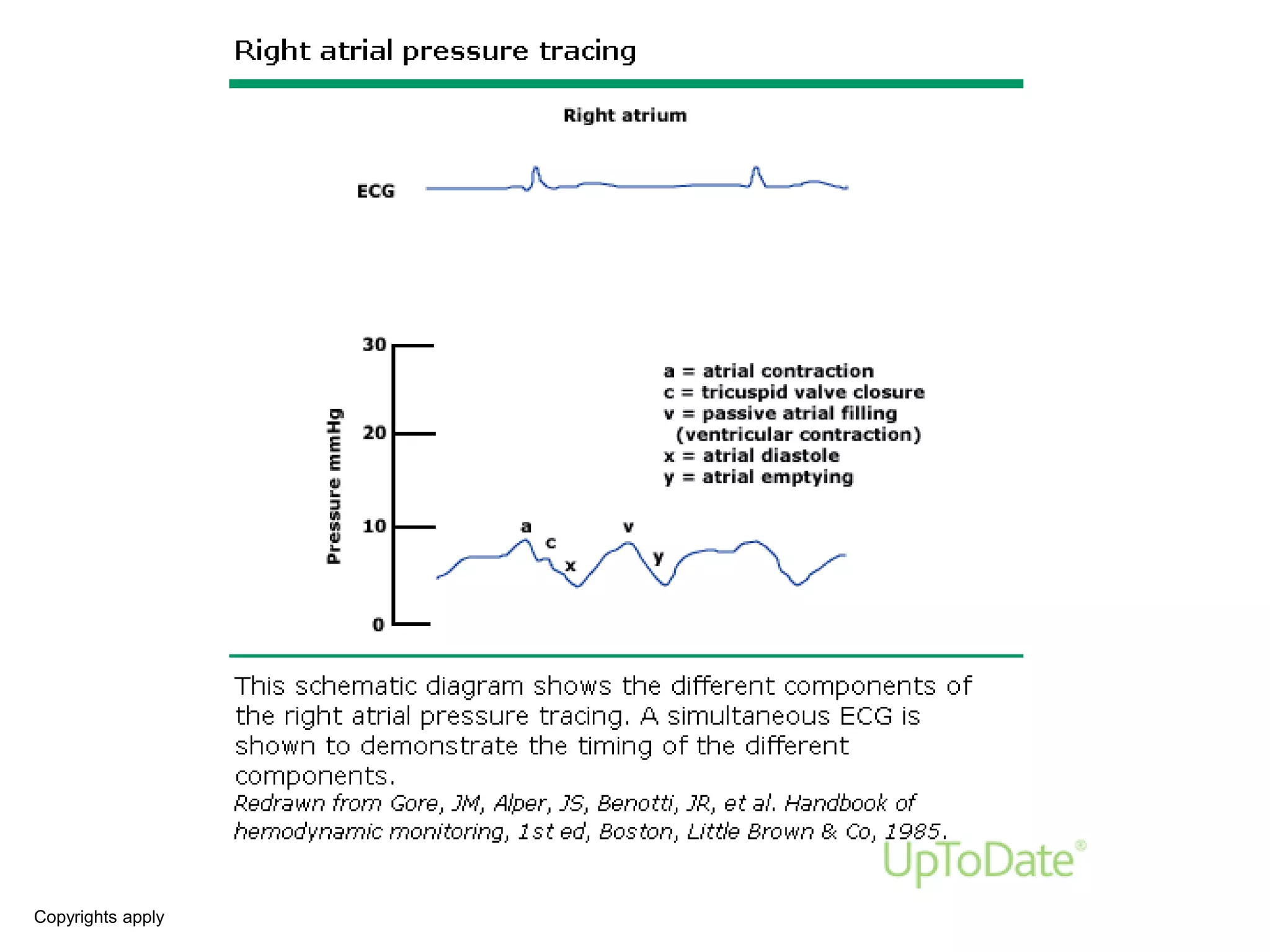 Right atrial pressure tracing | PPT