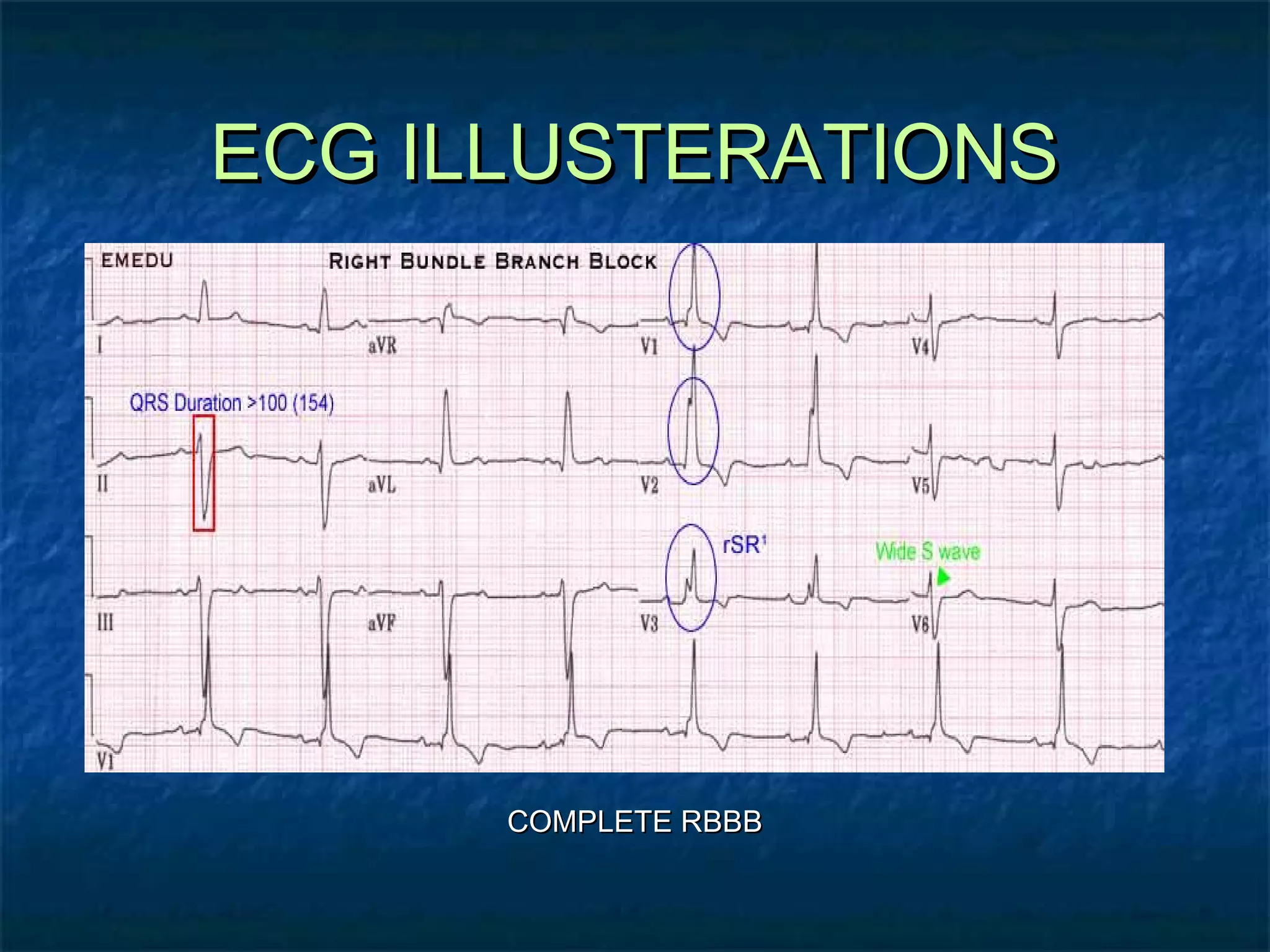 Right bundle branch block | PPT