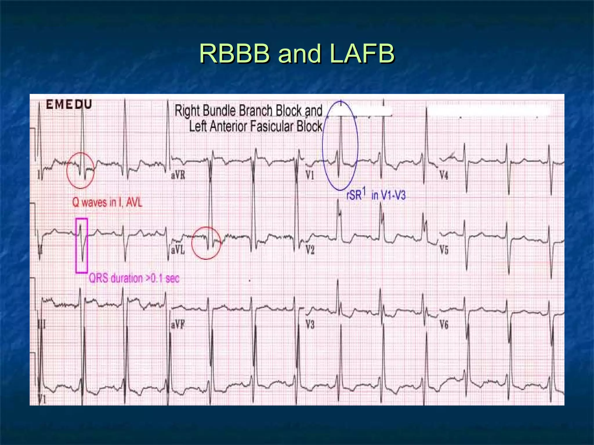 Right bundle branch block | PPT