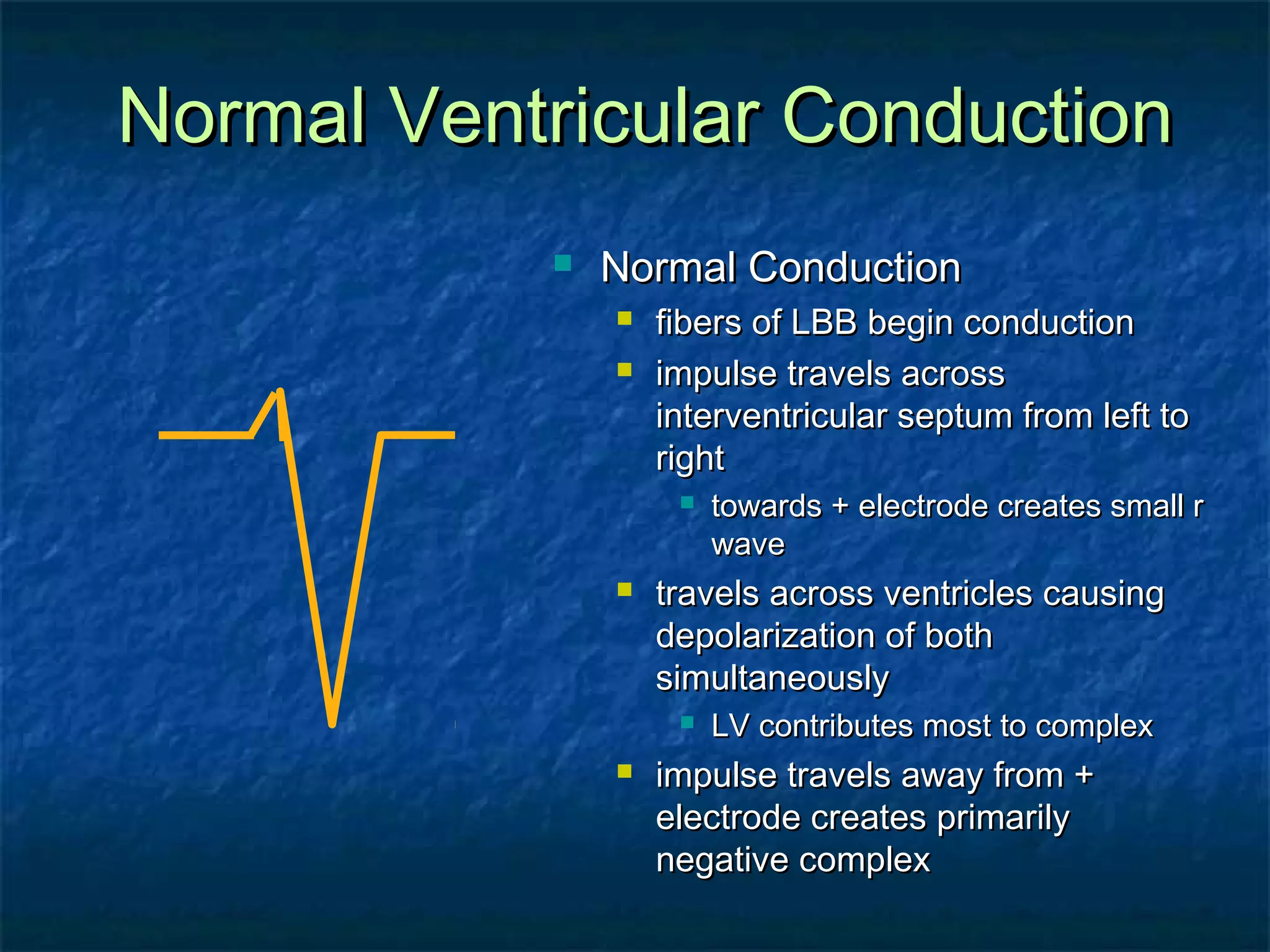 Right bundle branch block | PPT