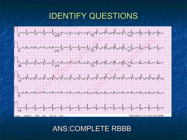 Right bundle branch block | PPT