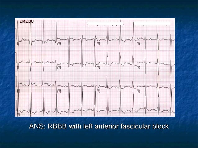 Right bundle branch block | PPT