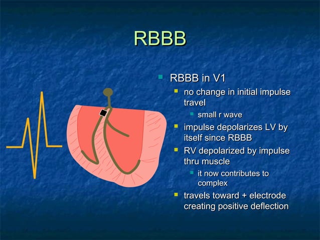 Right bundle branch block | PPT