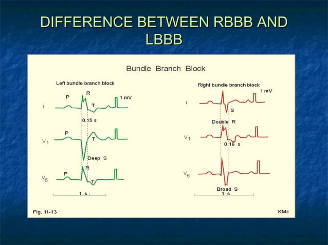 Right bundle branch block | PPT