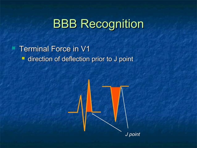 Right bundle branch block | PPT