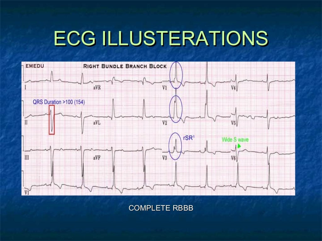 Right bundle branch block