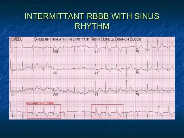 Right bundle branch block