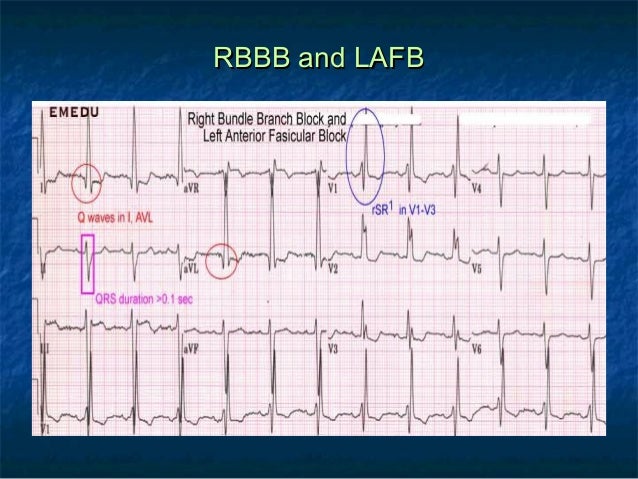 Right bundle branch block
