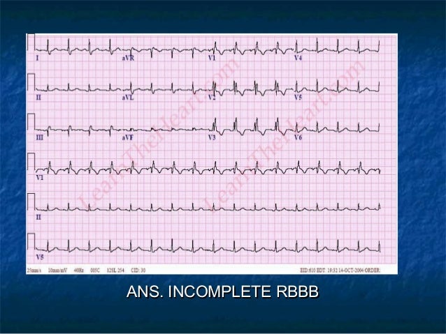 Right bundle branch block