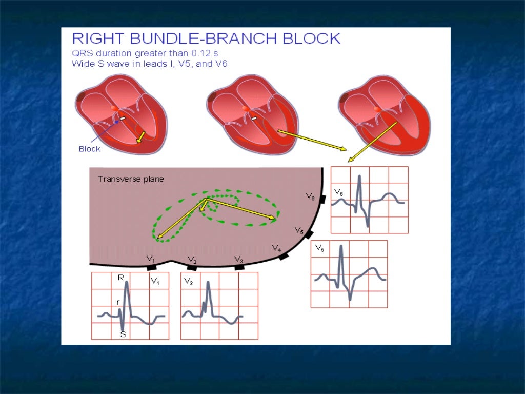 Right bundle branch block