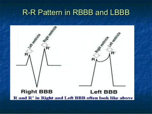 Right bundle branch block