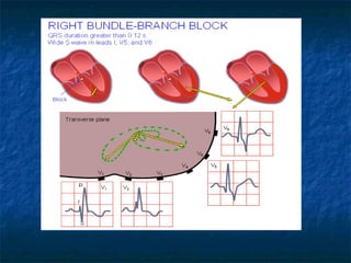 Right bundle branch block | PPT