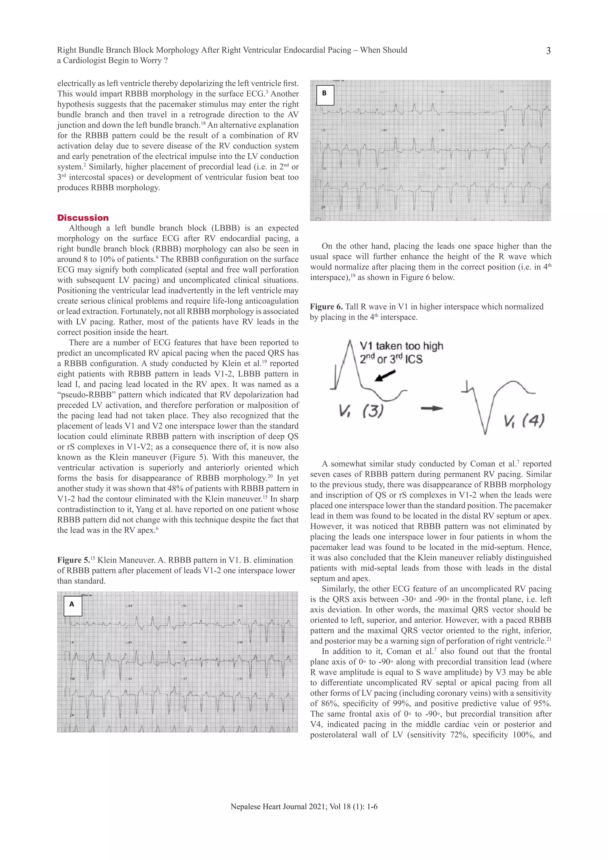 Right bundle branch block morphology after right ventricular ...