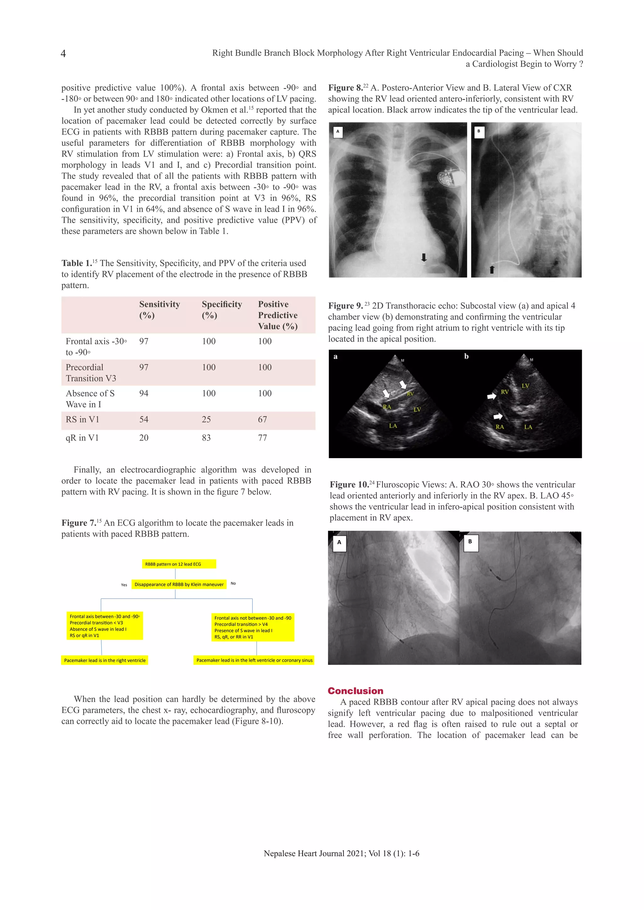 Right bundle branch block morphology after right ventricular ...