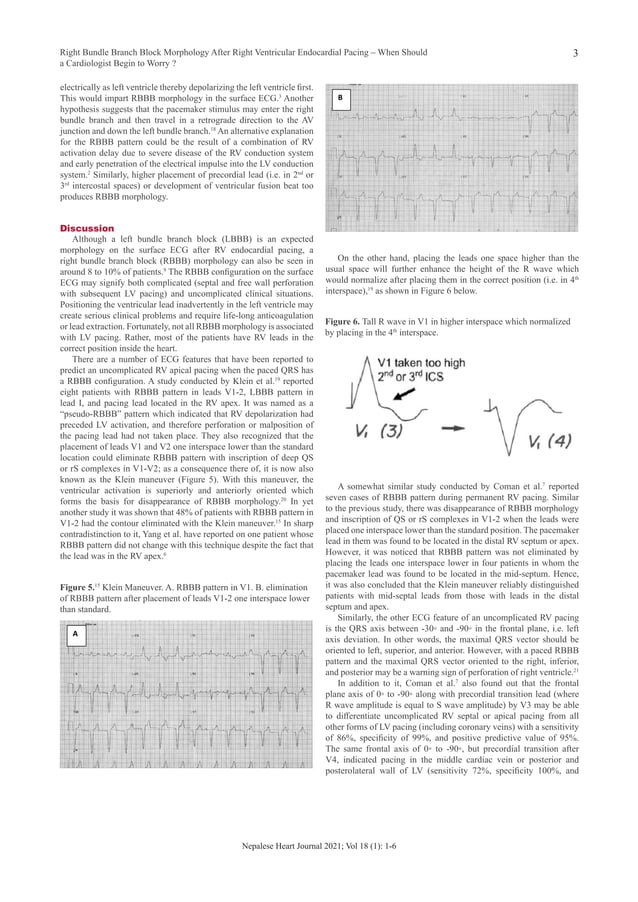 Right bundle branch block morphology after right ventricular ...