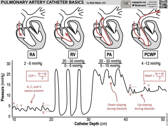 RIGHT HEART CATHETERISTION 1.ppt | Heart and Cardiovascular Diseases ...
