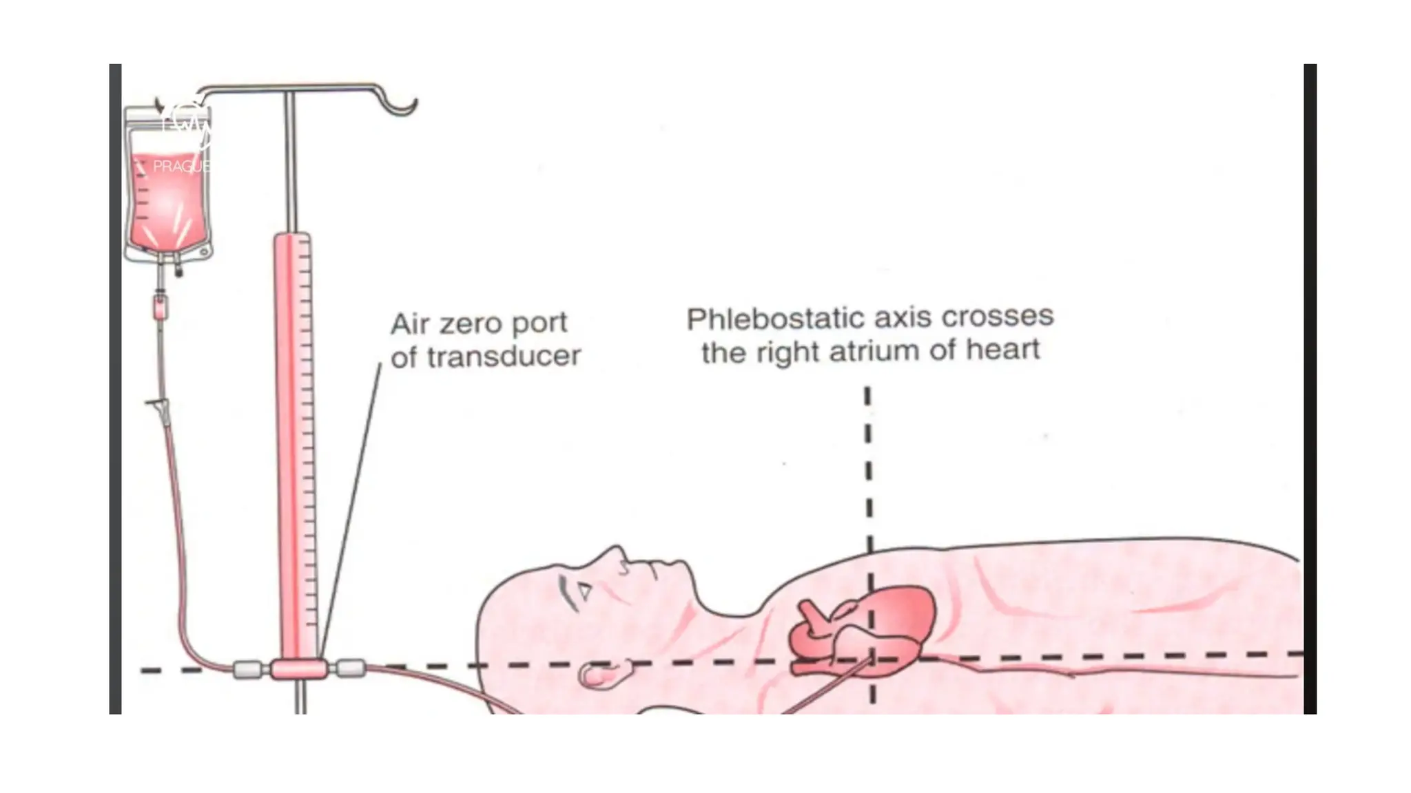 RIGHT HEART CATHETERIZATION (RHC) STUDY.pptx