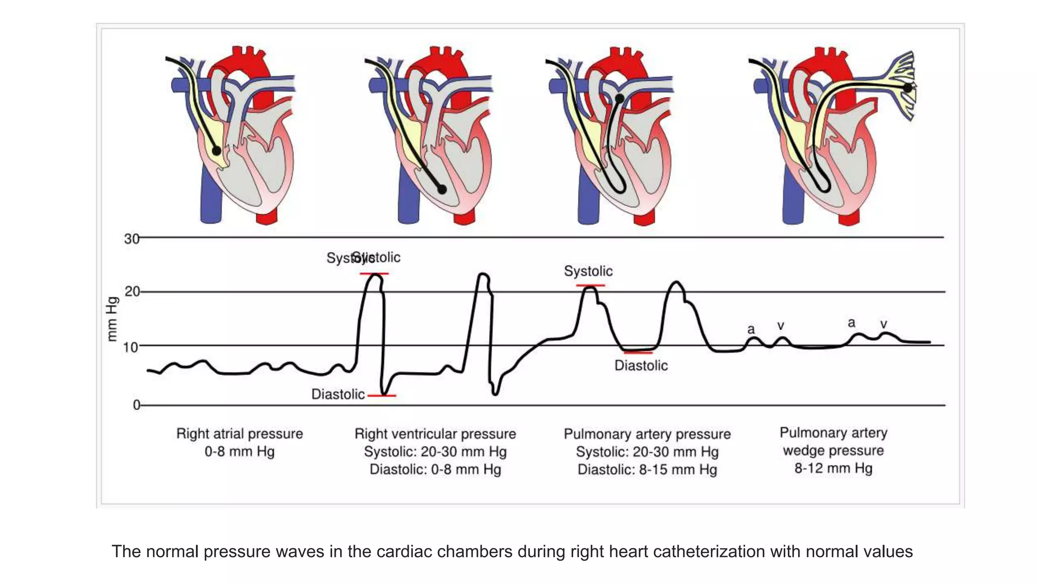 Right heart cathterization AL-AMIN.pptx