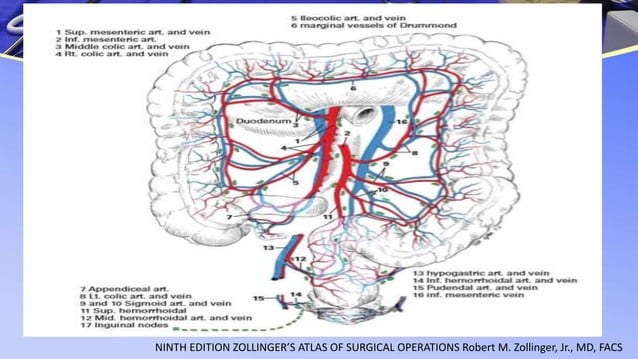 Right Hemicolectomy Ppt