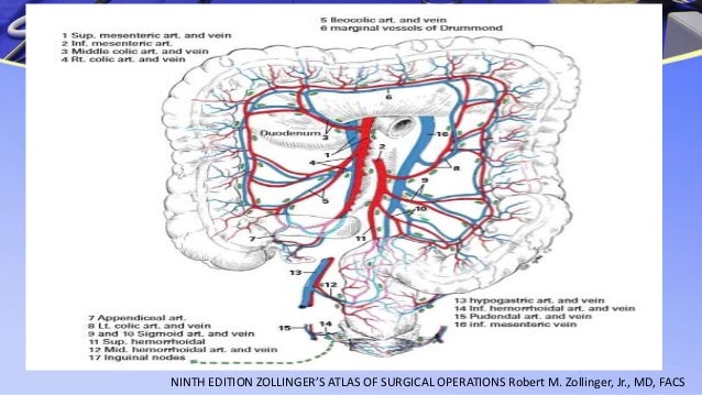 Right Hemicolectomy
