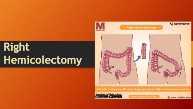 right hemicolectomy.pptx
