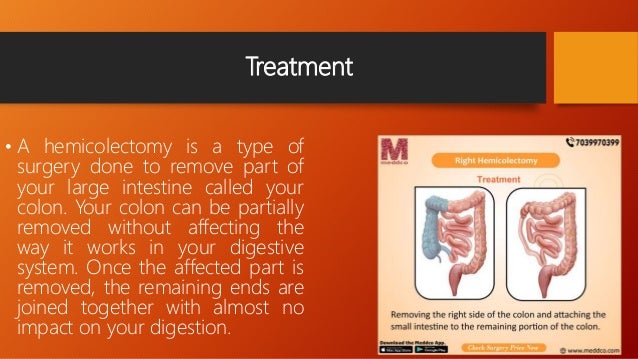 right hemicolectomy.pptx