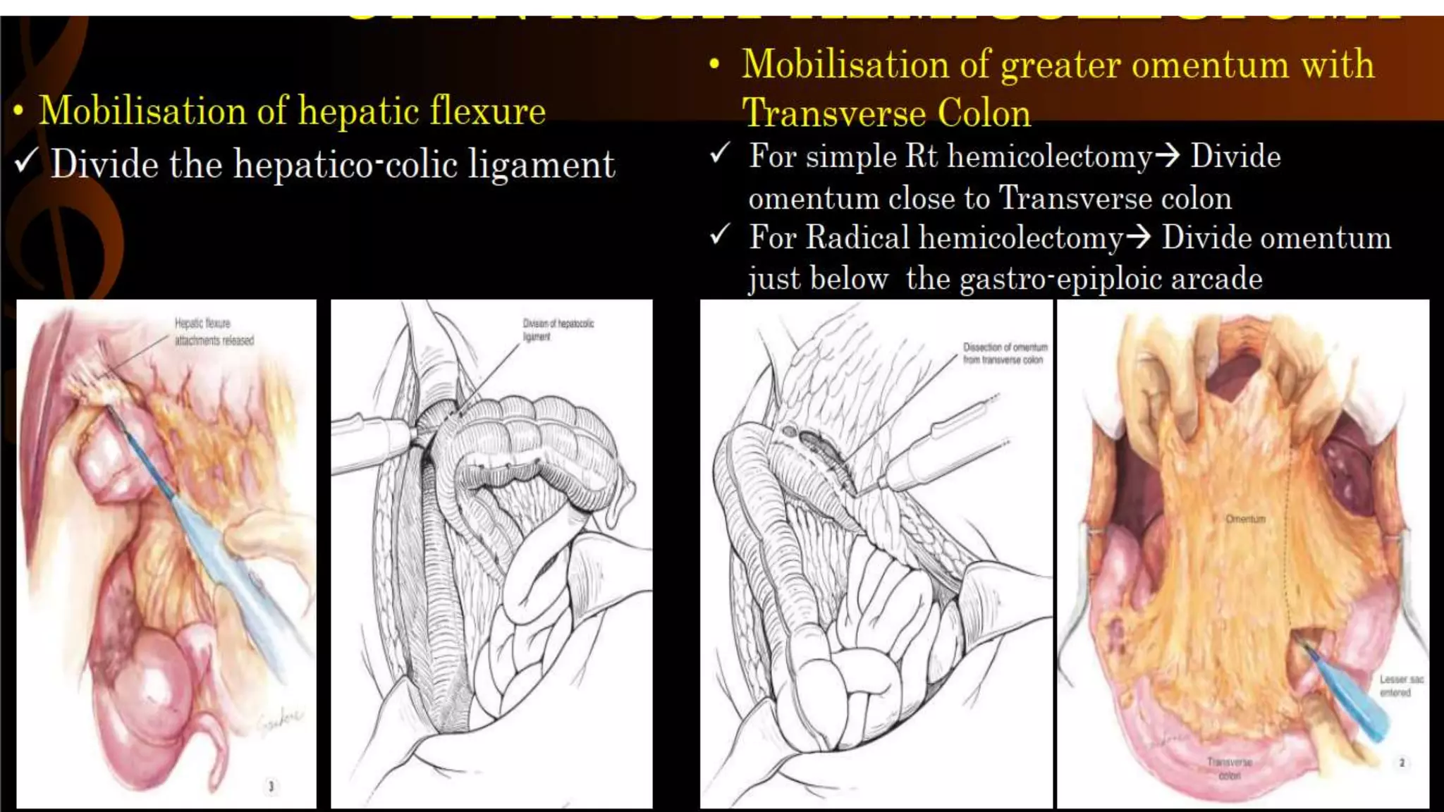 Right Hemicolectomy.pptx