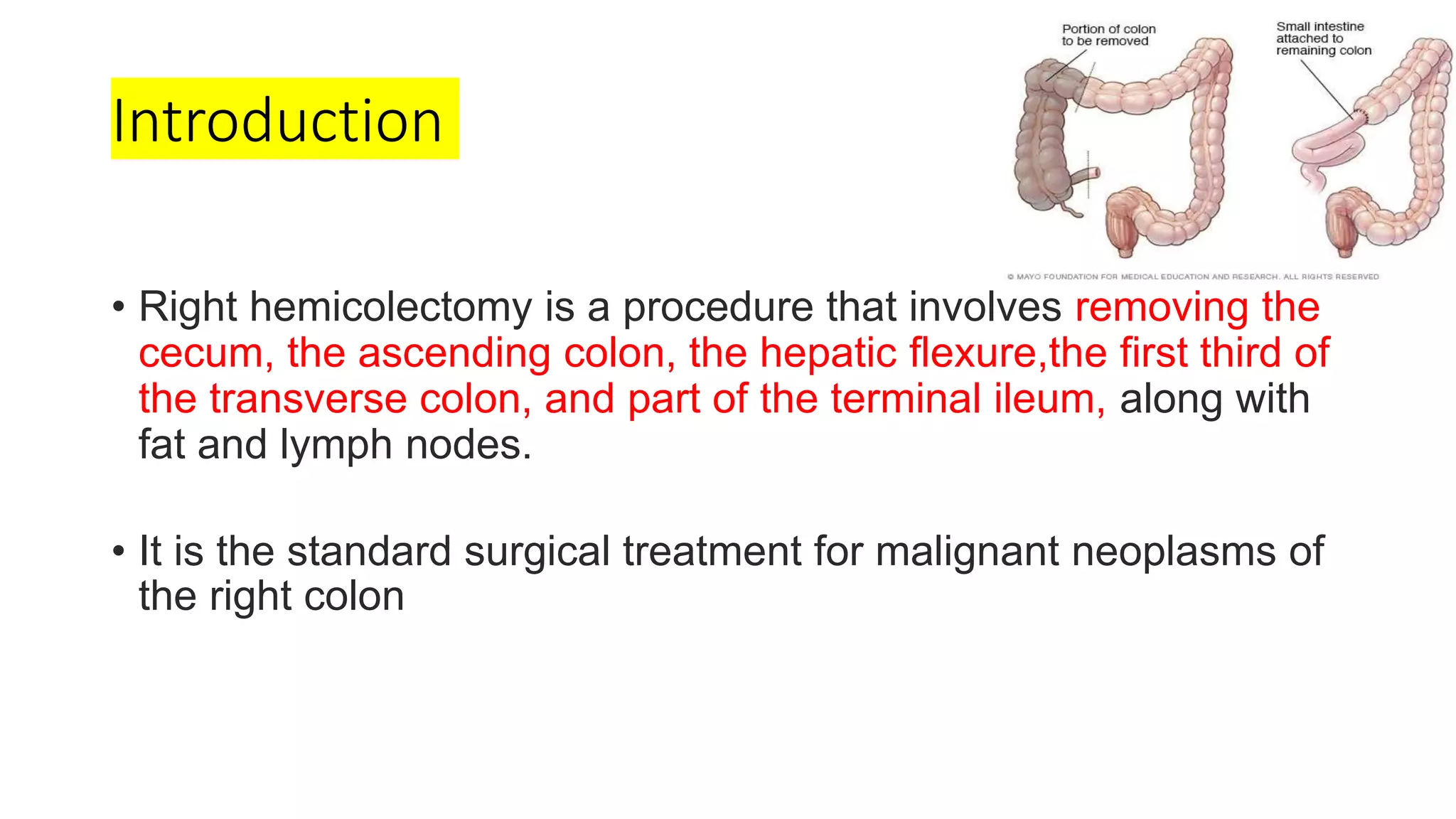 Right Hemicolectomy.pptx