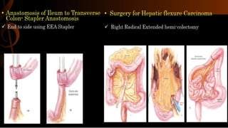 Right Hemicolectomy.pptx
