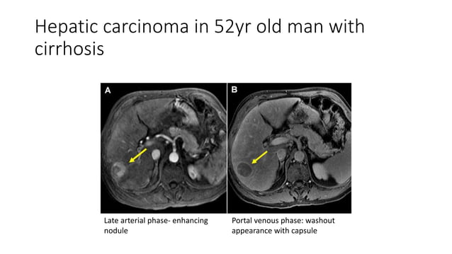 Right Hypochondrial Masses.pptx | Digestive Disorders | Diseases and ...