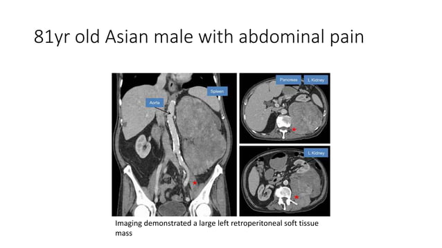 Right Hypochondrial Masses.pptx | Digestive Disorders | Diseases and ...