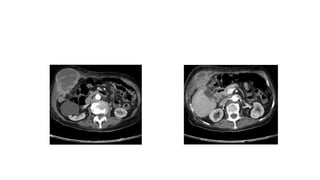 Right Hypochondrial Masses.pptx