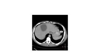 Right Hypochondrial Masses.pptx
