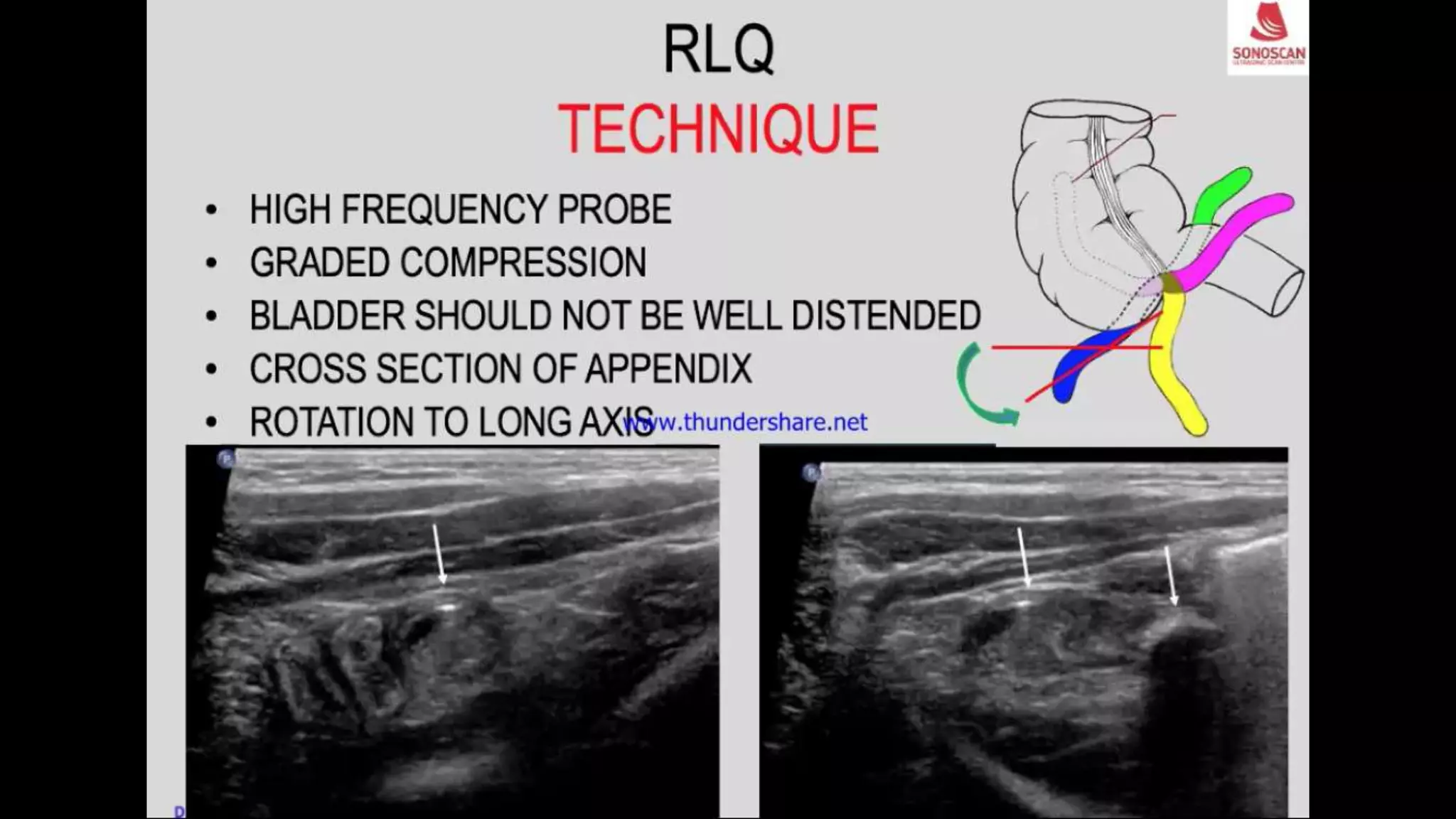 Right Iliac Fossa Evaluation.pptx