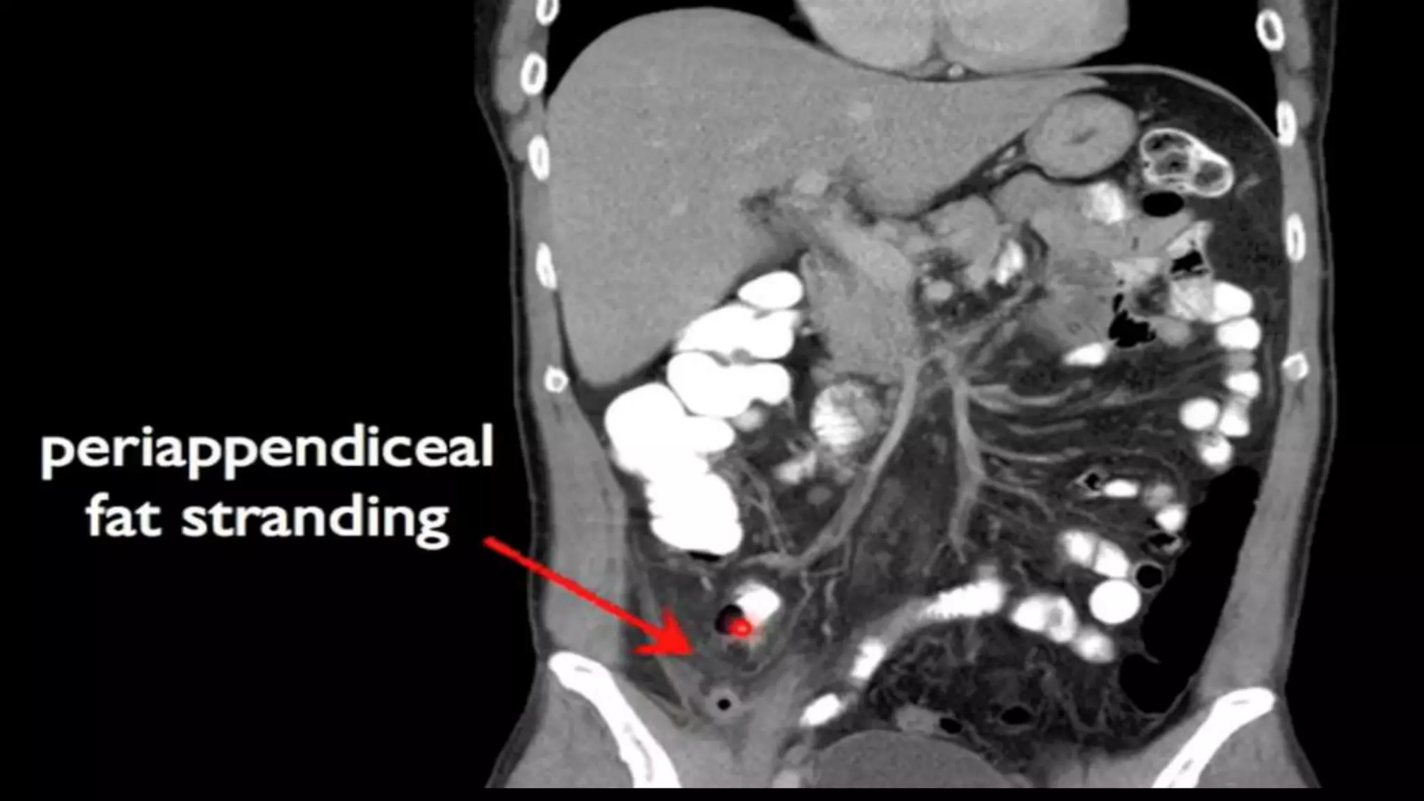 Right Iliac Fossa Evaluation.pptx