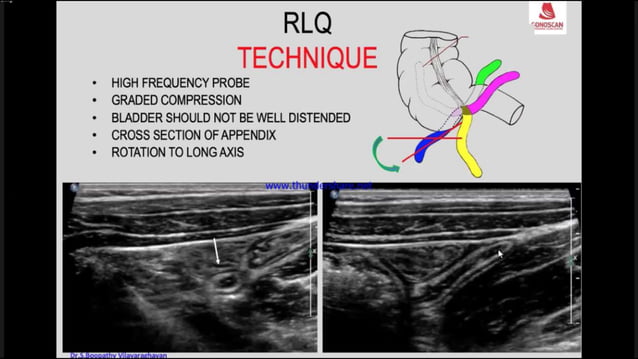 Right Iliac Fossa Evaluation.pptx