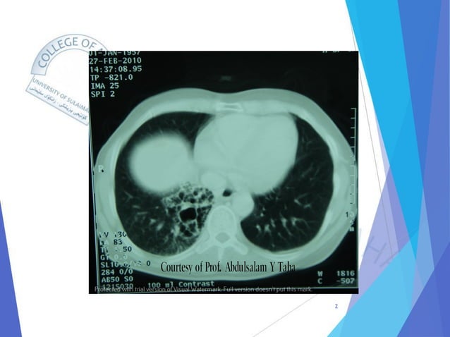 Right Lower Lobe Bronchiectasis.pdf
