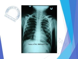 Right Main Stem Bronchus Foreign Body with Subcutaneous Emphysema.pdf